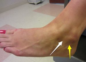 Sprained Ankle | Dr Geier