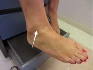 Osteochondral Lesion of the Talus | Dr Geier