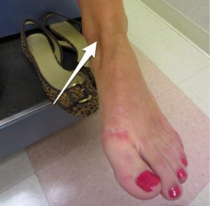 Osteochondral Lesion of the Talus | Dr Geier