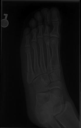 Fifth Metatarsal Fracture - Jones fracture | Dr Geier