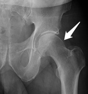 Femoroacetabular Impingement - FAI | Dr Geier