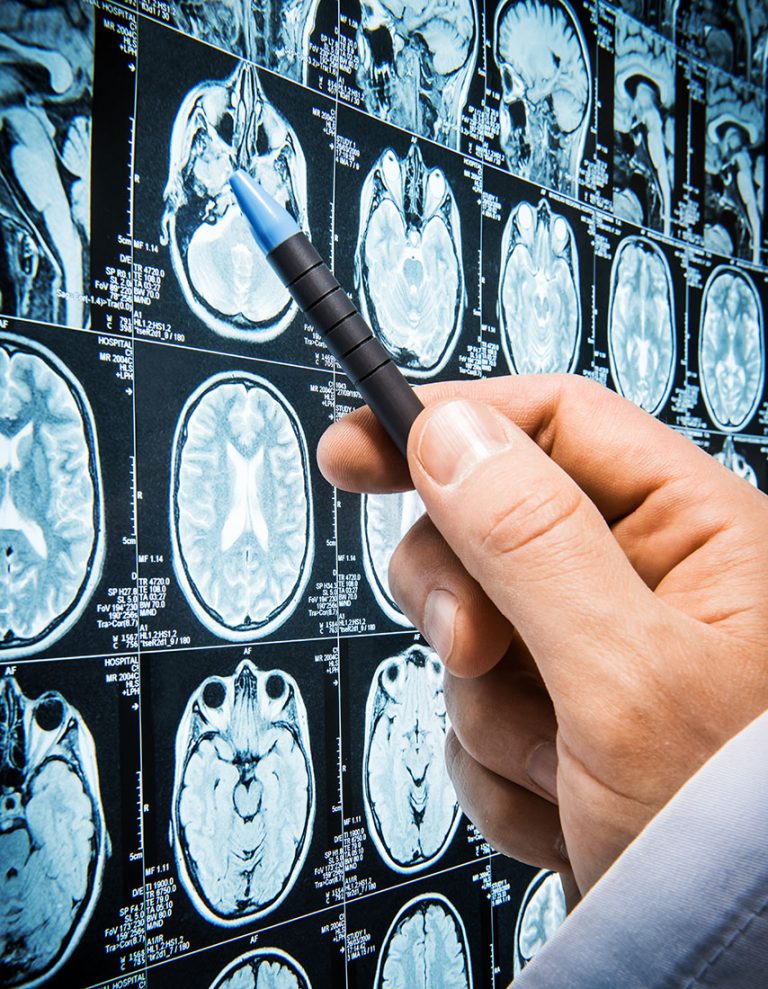 Chronic traumatic encephalopathy (CTE) | Dr Geier