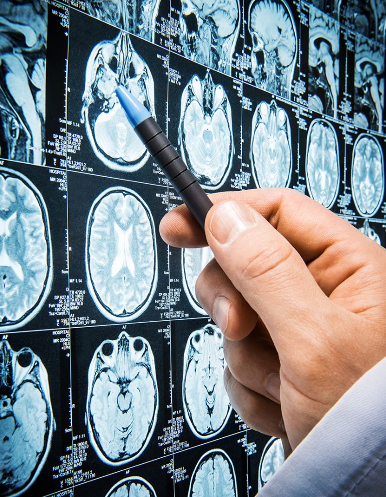 Chronic traumatic encephalopathy (CTE) | Dr Geier