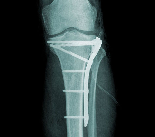 What does surgery and rehab of a tibial plateau fracture entail? | Dr Geier