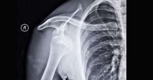 Signs your shoulder injury is serious | Dr Geier
