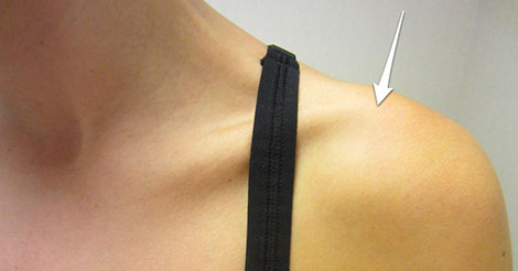 Distal clavicle osteolysis: A common shoulder injury for weightlifters ...