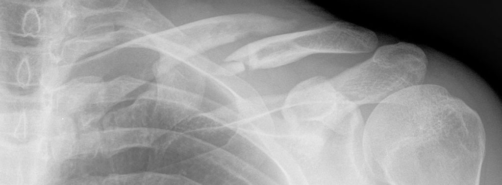 Clavicle fracture: Mechanism of injury and treatment options for this ...