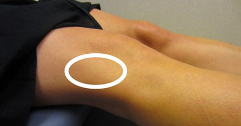 Iliotibial band (IT band) syndrome: Common cause of knee pain in ...