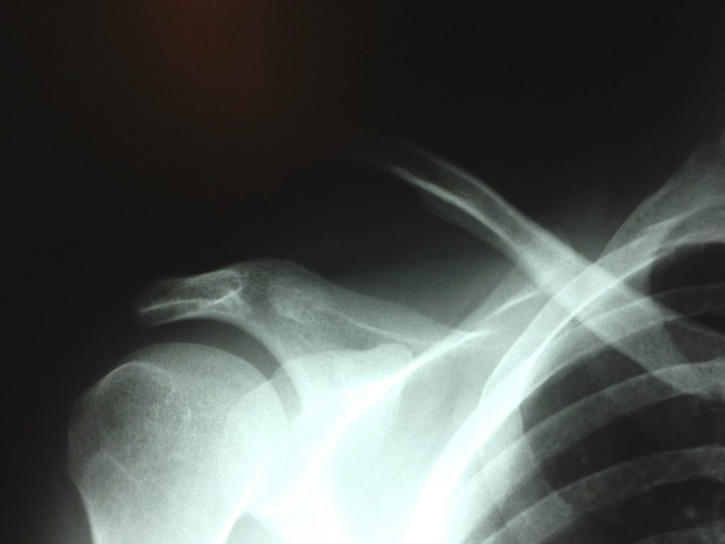 AC injury: Mechanism of injury, diagnosis and treatment of this ...