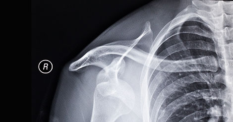 Shoulder dislocations: Initial management and treatment | Dr Geier