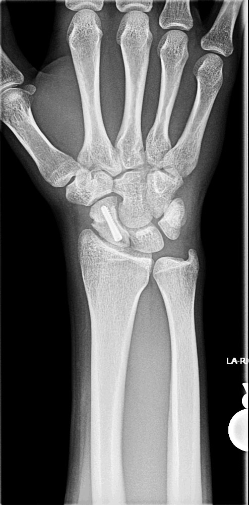 Scaphoid fracture: Mechanism of injury and treatment options of this ...