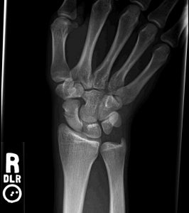 Scaphoid fracture: Mechanism of injury and treatment options of this ...