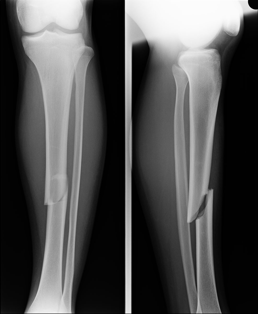 What can cause a fracture to have delayed healing? | Dr Geier