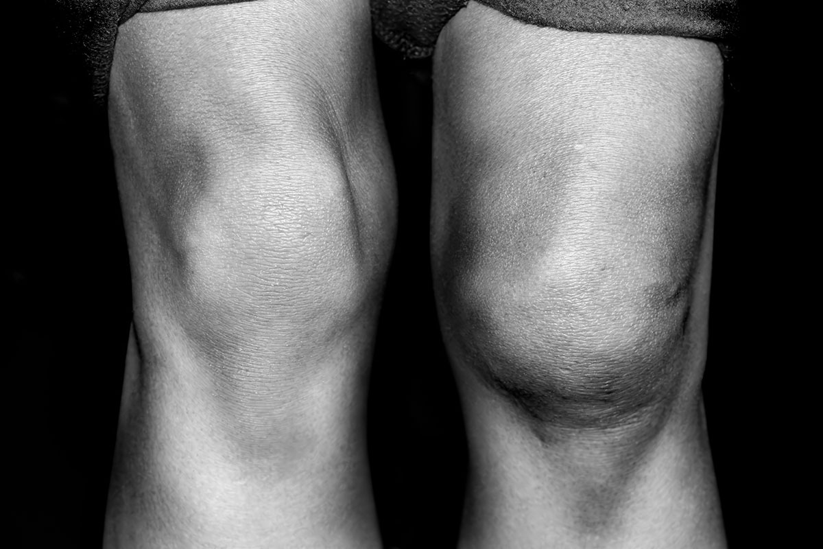 My knee is swollen. Should I be worried? | Dr Geier