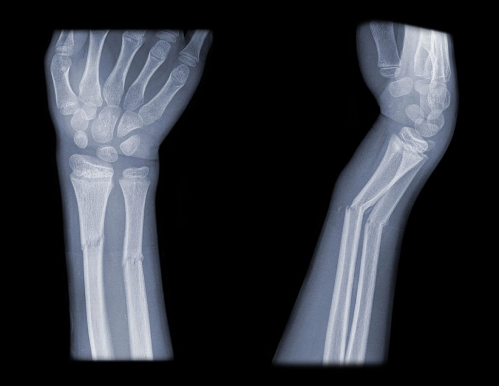 How to know if you broke a bone | Dr Geier