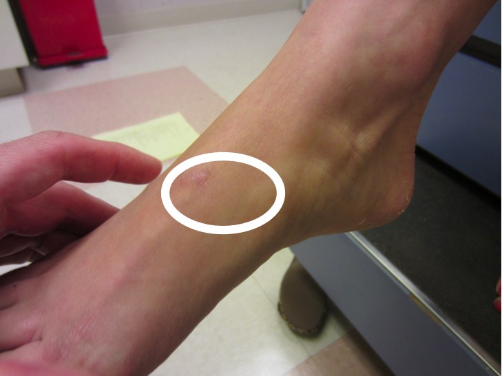 Lisfranc injury: Understanding this challenging foot injury | Dr Geier
