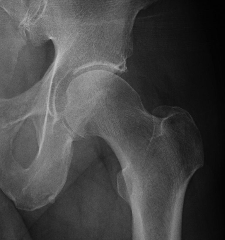 FAI – Femoroacetabular impingement | Dr Geier