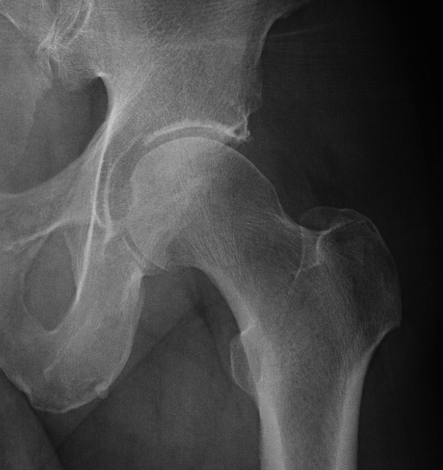 FAI – Femoroacetabular impingement | Dr Geier