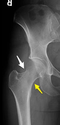 Femoral neck stress fracture: Signs, symptoms, diagnosis, and treatment ...