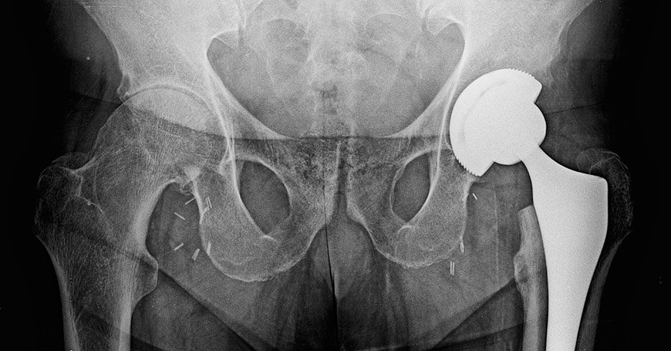 Avascular necrosis of the hip | Dr Geier