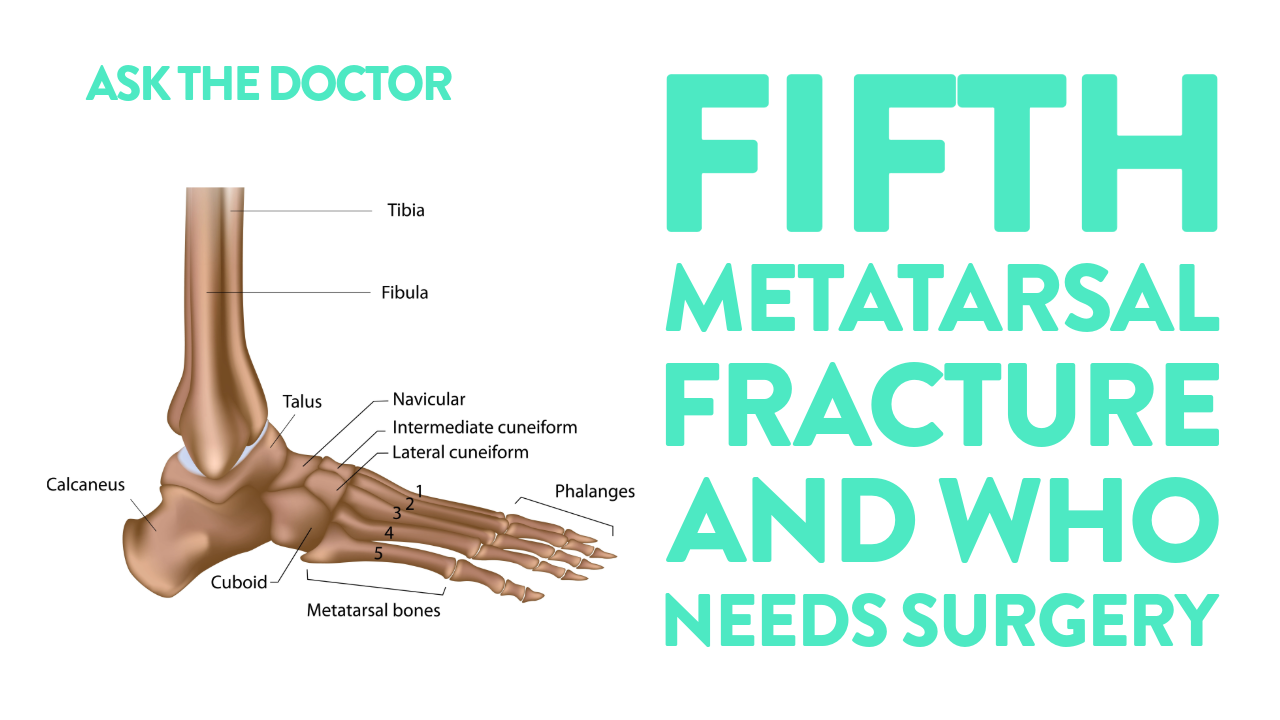 Ask the Doctor: Fifth metatarsal fracture and who needs surgery | Dr Geier